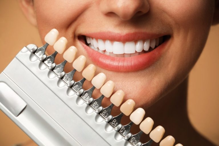 Benefits of Choosing Same-Day Veneers for Smile Makeovers